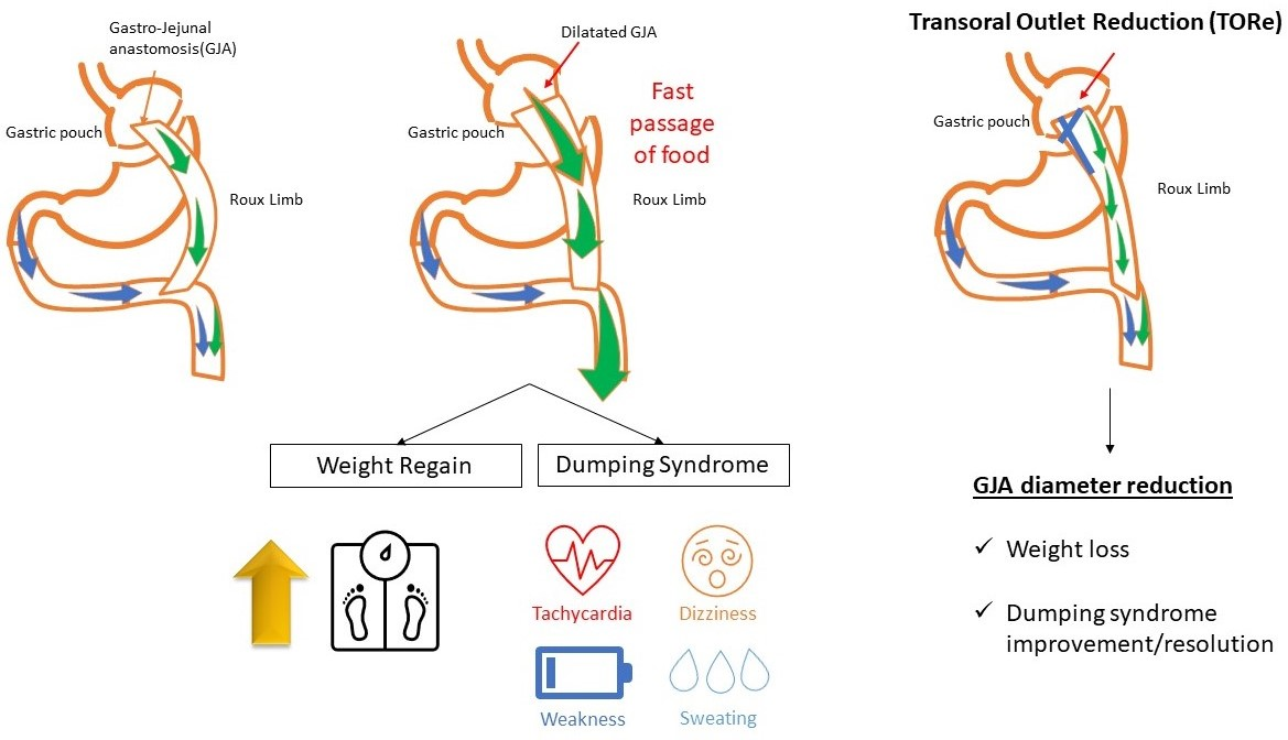 JPM Free Full Text Weight Recidivism And Dumping Syndrome After