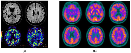 Depressive Pseudodementia with Reversible AD-like Brain Hypometabolism ...