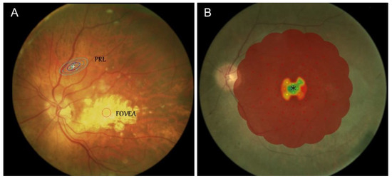 Posturographic Analysis in Patients Affected by Central and Peripheral ...