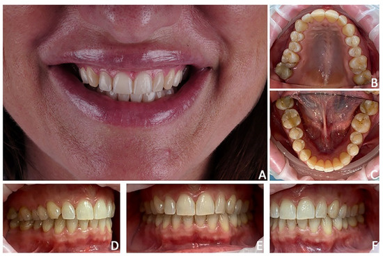 Prosthetically Guided Orthodontics (PGO): A Personalized Clinical ...