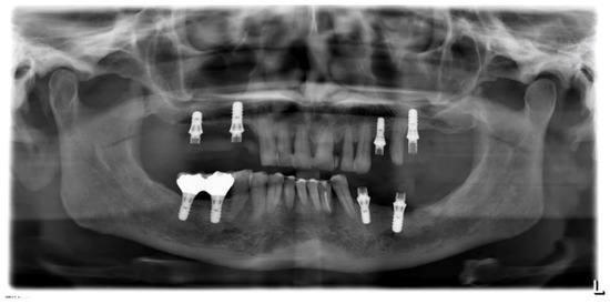 Prosthetically Guided Orthodontics (PGO): A Personalized Clinical ...