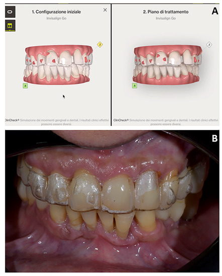 Prosthetically Guided Orthodontics (PGO): A Personalized Clinical ...
