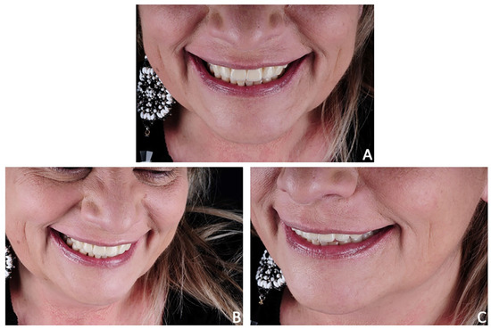 Prosthetically Guided Orthodontics (PGO): A Personalized Clinical ...