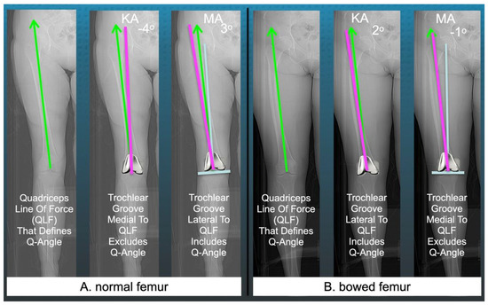 The Trochlear Groove of a Femoral Component Designed for Kinematic Alignment Is Lateral to the ...