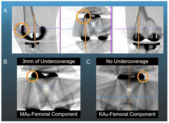 The Trochlear Groove of a Femoral Component Designed for Kinematic ...