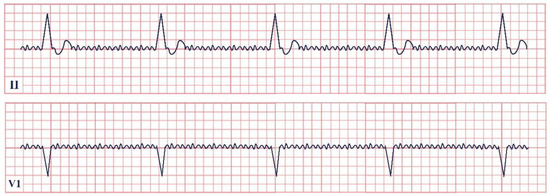 Broad Electrocardiogram Syndromes Spectrum: From Common Emergencies to ...