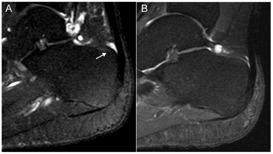 Longitudinal Follow-Up Using the Heel Enthesitis Magnetic Resonance ...