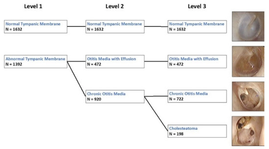 Normal Tympanic Membrane Labeled
