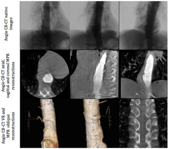 JPM | Free Full-Text | Angio Cone-Beam CT (Angio-CBCT) and 3D Road ...