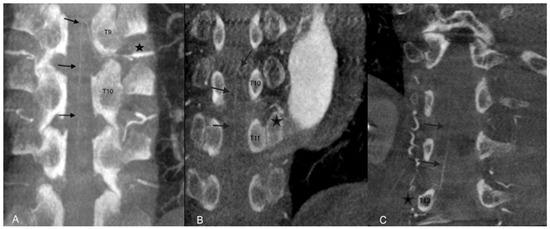 Angio Cone-Beam CT (Angio-CBCT) and 3D Road-Mapping for the Detection ...