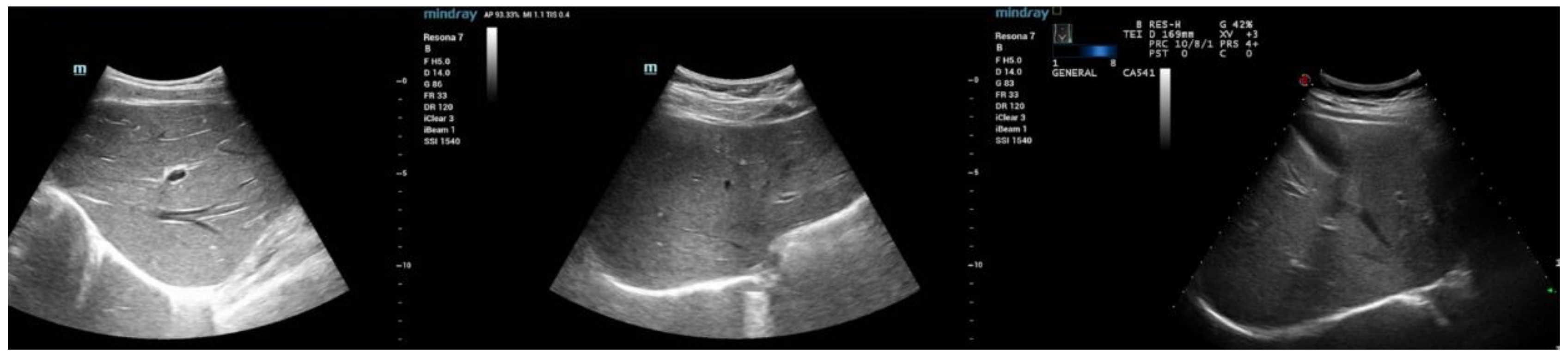 Predictive Risk Factors of Nonalcoholic Fatty Liver Disease in a Lean ...