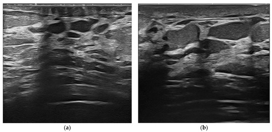 Use of High-Frequency Transducers in Breast Sonography