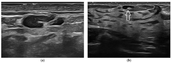 Use of High-Frequency Transducers in Breast Sonography