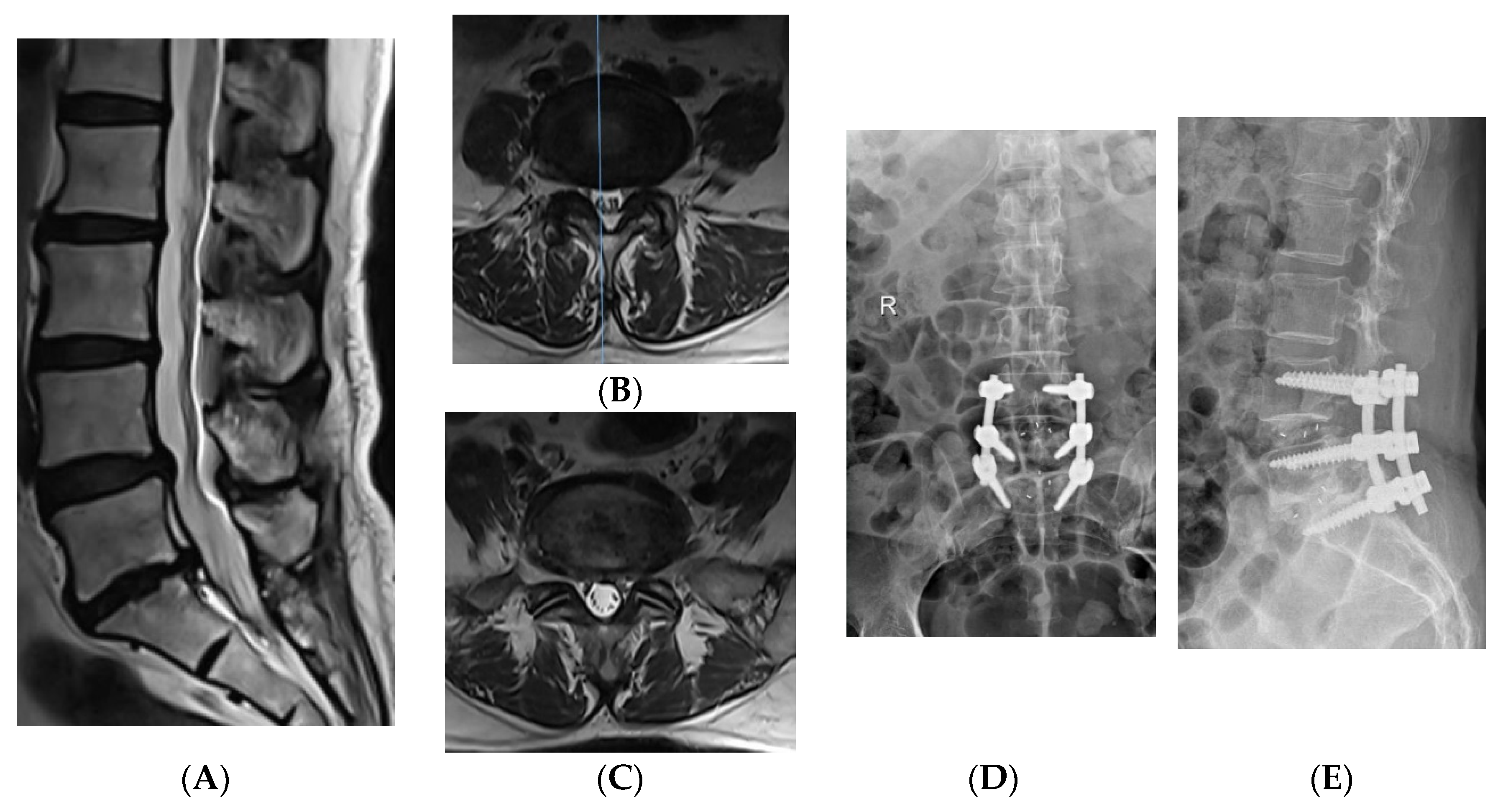 Which Is Better in Clinical and Radiological Outcomes for Lumbar ...