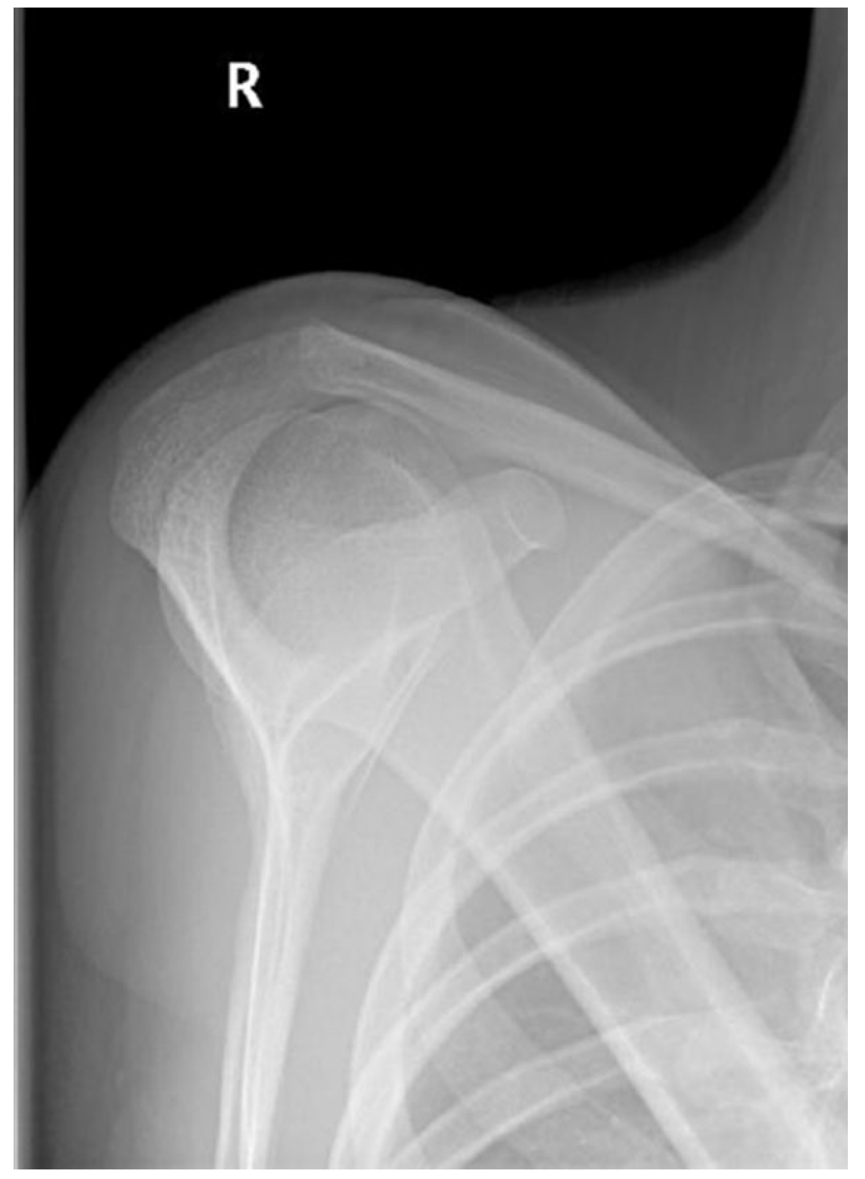 JPM | Free Full-Text | Atraumatic Acromioclavicular Joint Dislocation ...