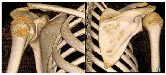 Atraumatic Acromioclavicular Joint Dislocation: A Case Report Treated ...