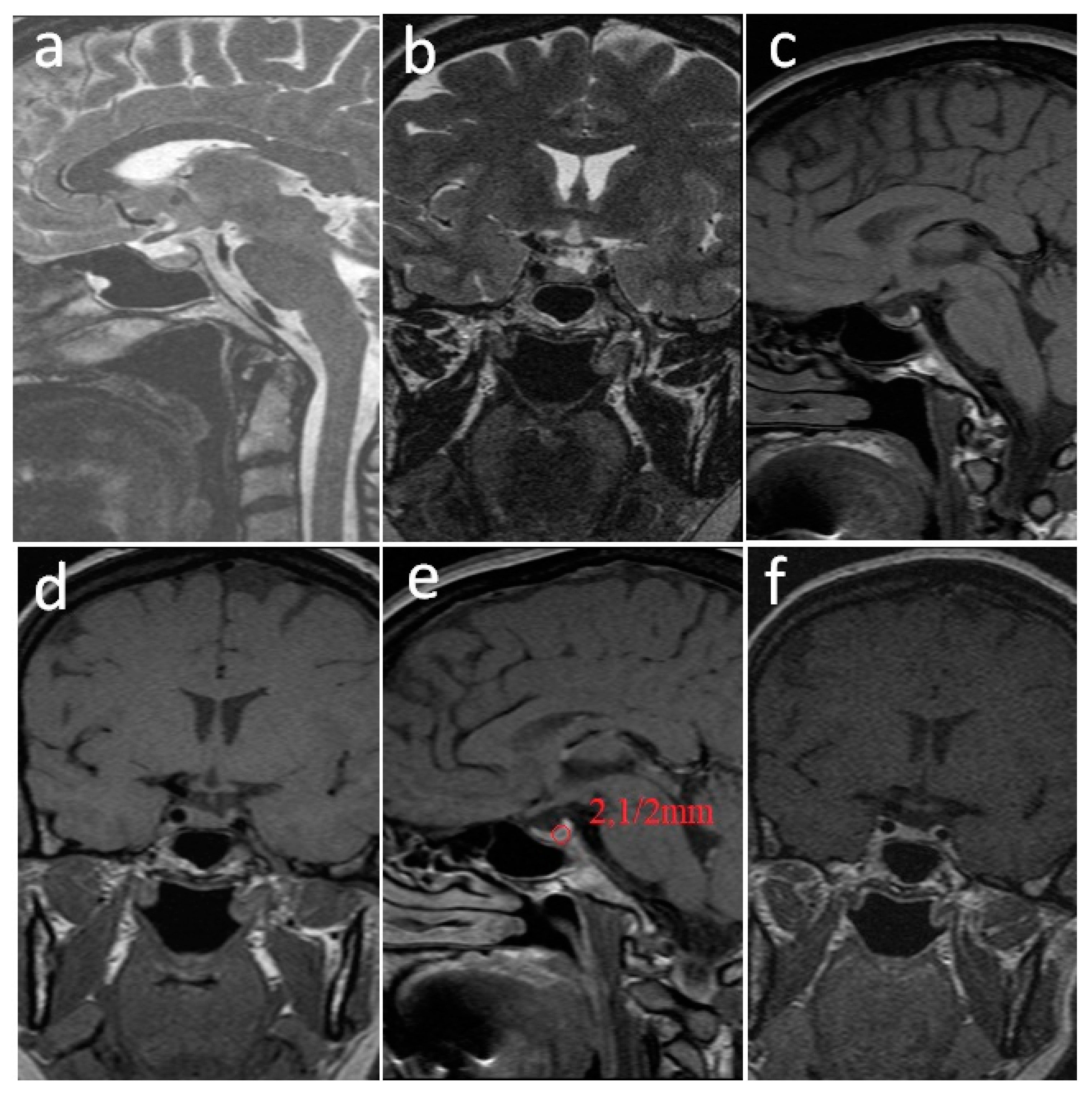 JPM | Free Full-Text | Cabergoline Failure and a Spontaneous Pregnancy ...