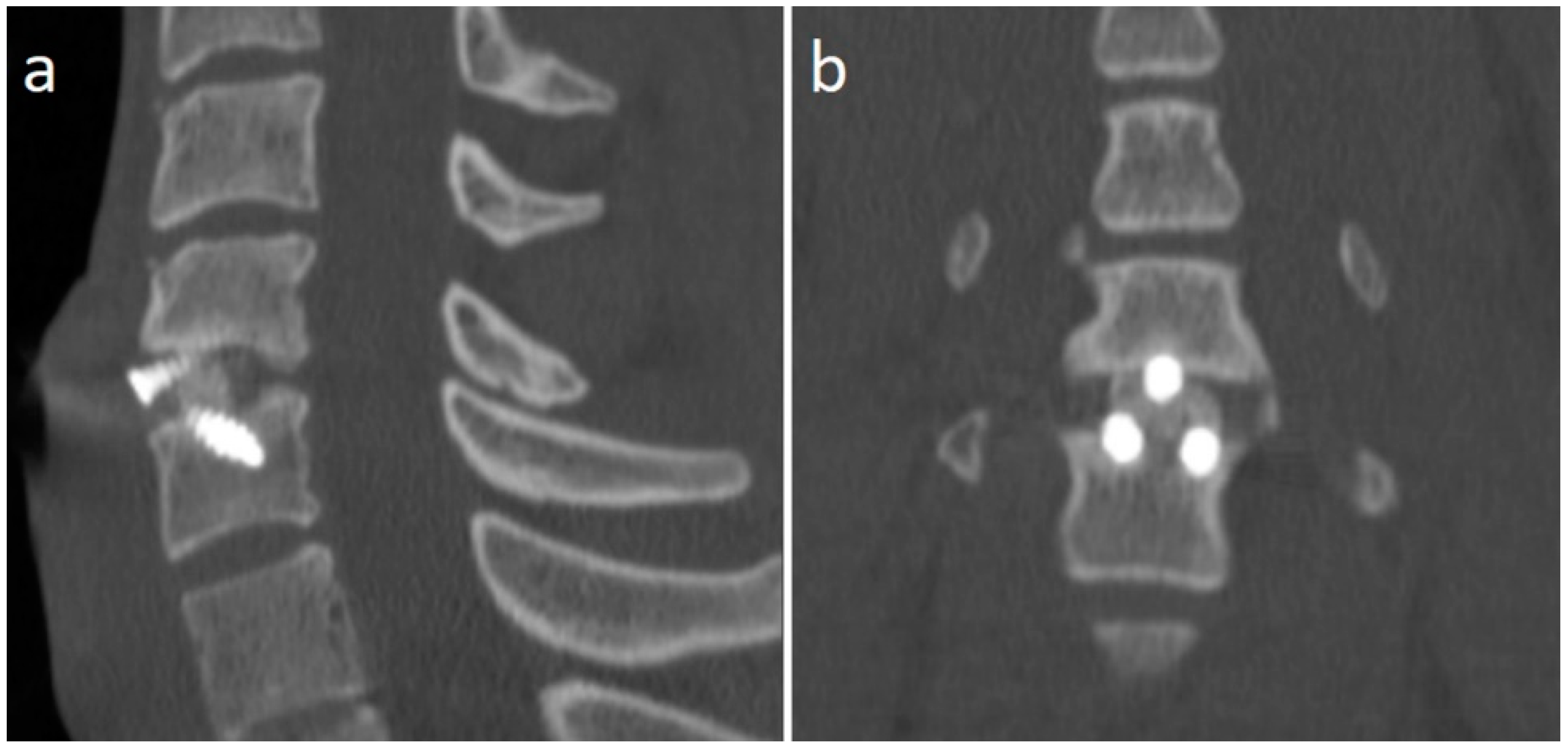 Return to Martial Arts after Surgical Treatment of the Cervical Spine ...
