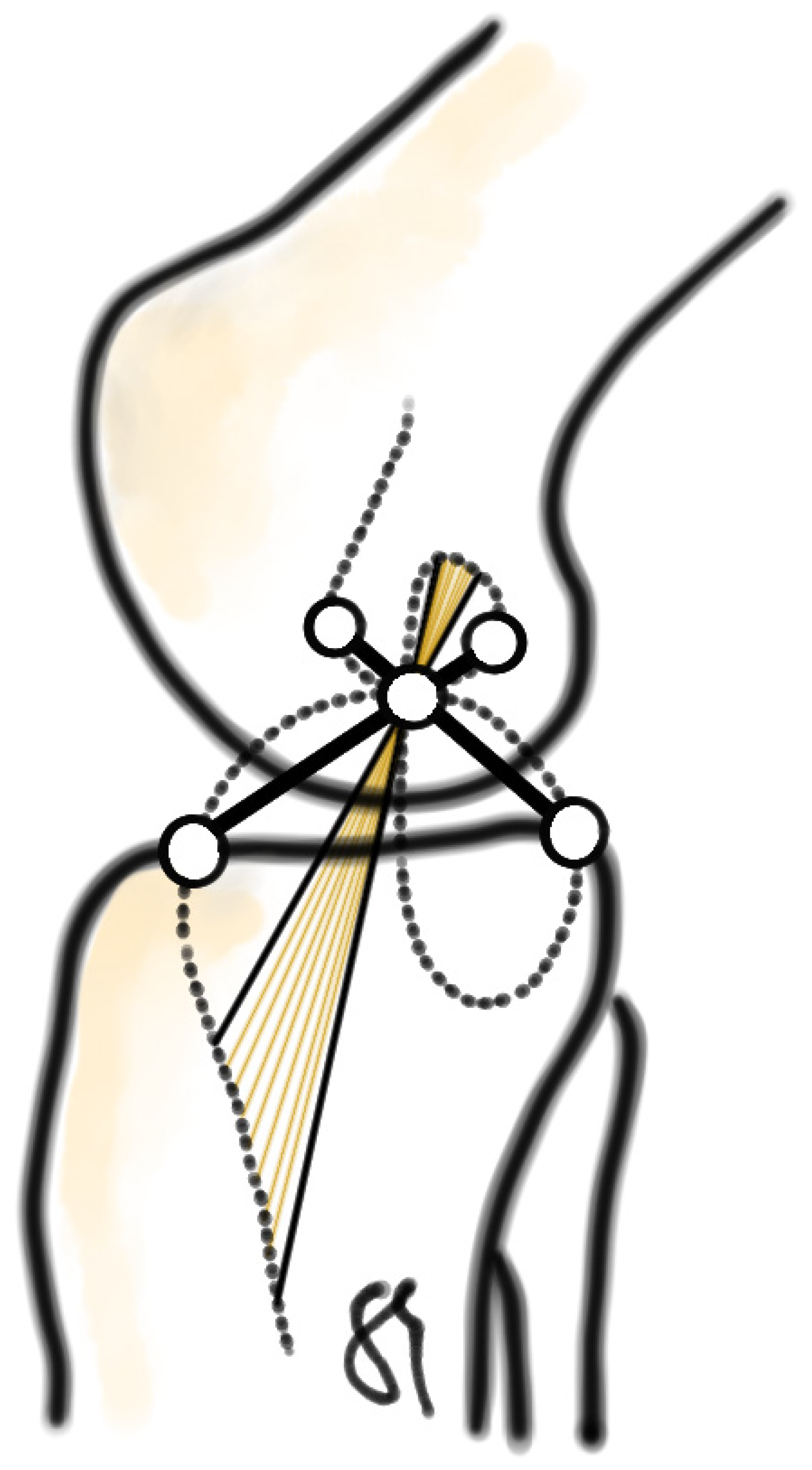 Total Knee Arthroplasty Violates the Law of Burmester—A Biomechanical ...