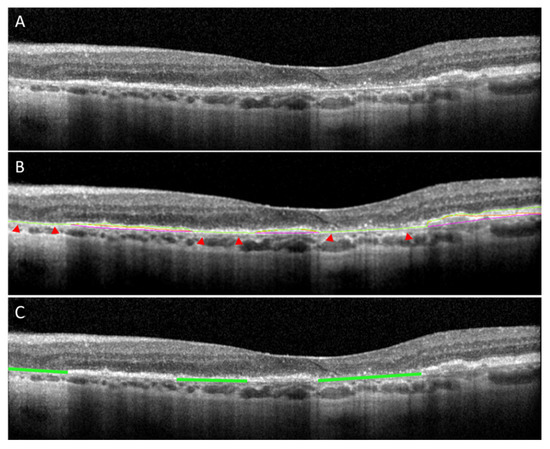 Machine Learning-Based Automated Detection and Quantification of ...