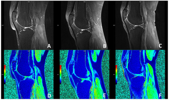 Results of Treating Mild to Moderate Knee Osteoarthritis with ...