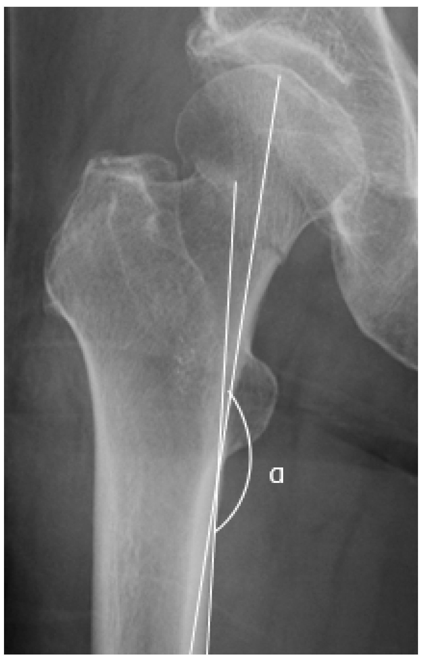 Reliability of the Garden Alignment Index and Valgus Tilt Measurement ...