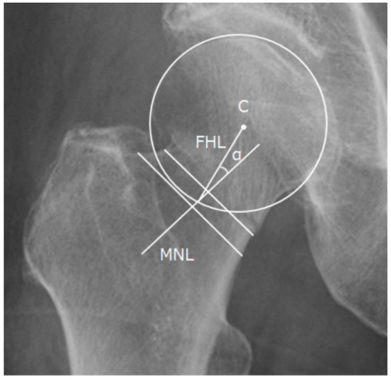 Reliability of the Garden Alignment Index and Valgus Tilt Measurement ...
