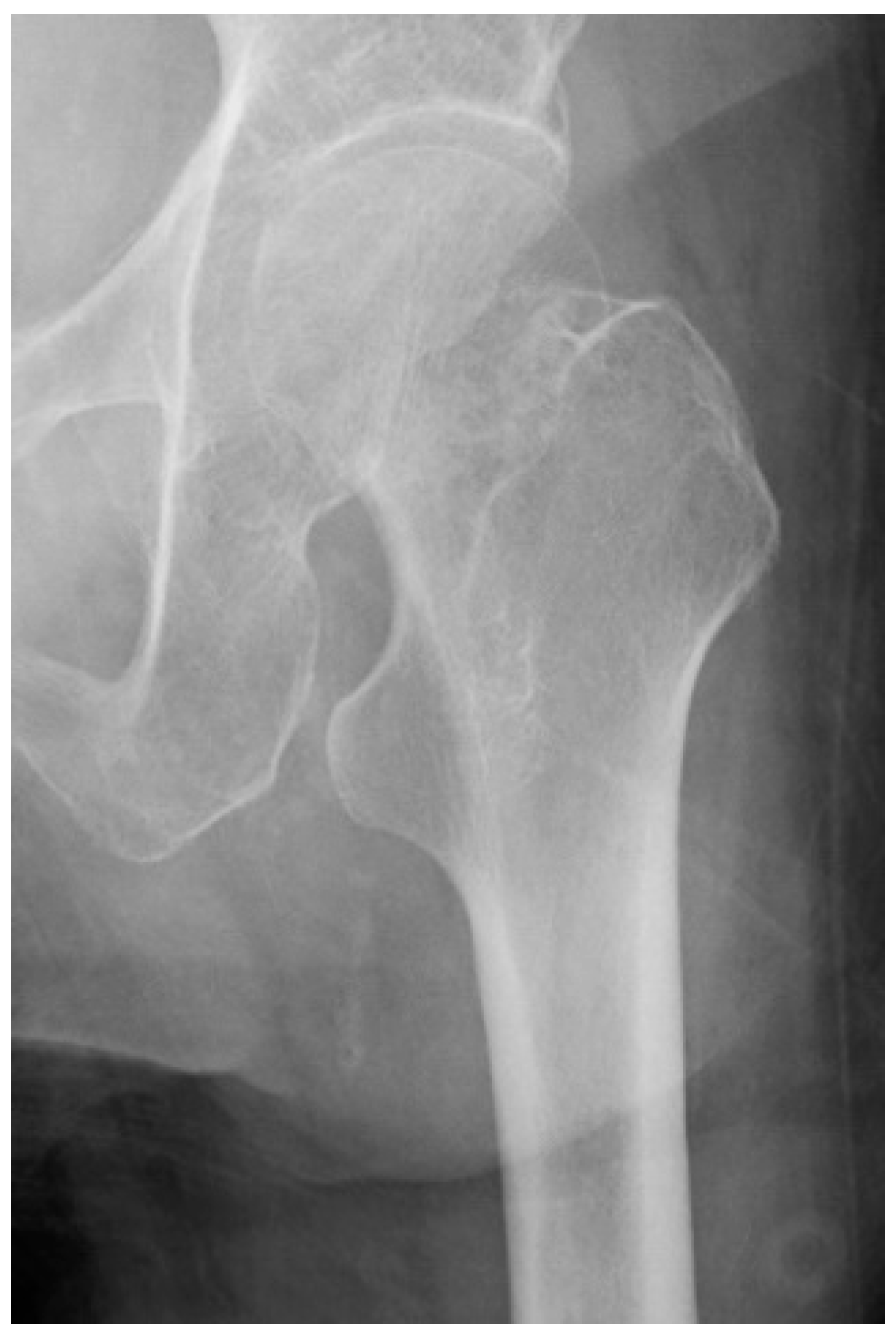 Reliability of the Garden Alignment Index and Valgus Tilt Measurement ...
