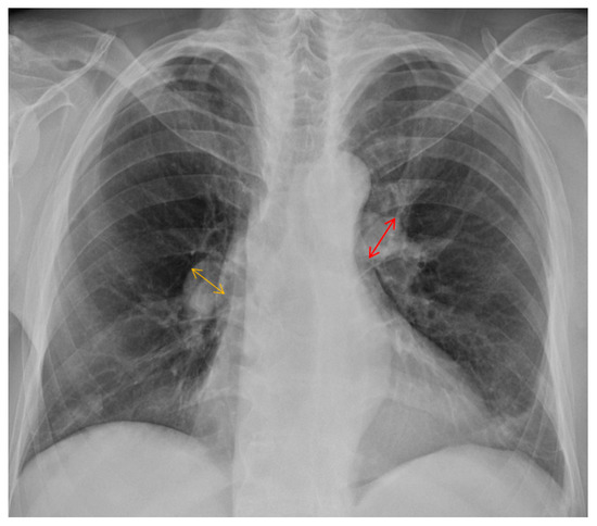 Case Report: A Rare Manifestation of Pulmonary Arterial Hypertension in ...