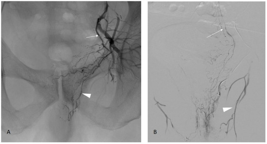 Prostate Artery Embolization: Challenges, Tips, Tricks, and Perspectives