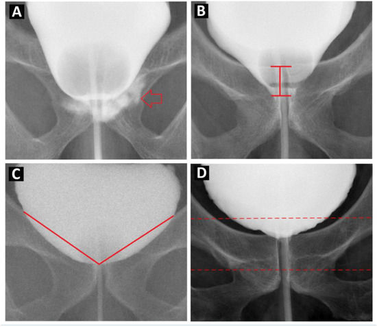 JPM | Free Full-Text | Recognition of Postoperative Cystography ...