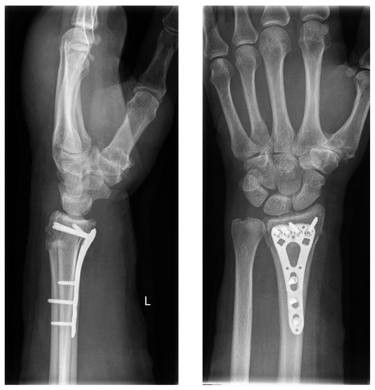 Outcome Analysis of Distal Radius Fracture with Orthosis Versus Cast ...