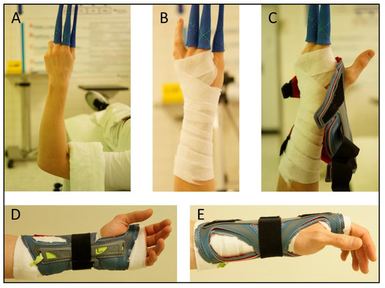 Outcome Analysis of Distal Radius Fracture with Orthosis Versus Cast ...