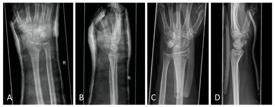 Outcome Analysis of Distal Radius Fracture with Orthosis Versus Cast ...