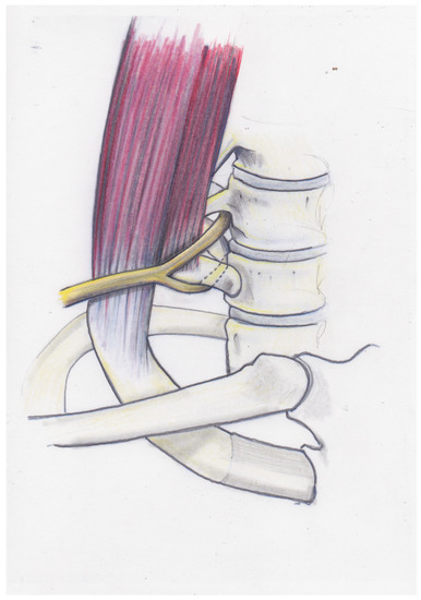 Relevance of Costovertebral Exarticulation of the First Rib in ...