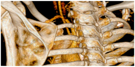 Relevance of Costovertebral Exarticulation of the First Rib in ...