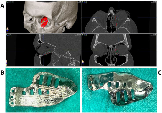 Plasma Electrolytic Polished Patient-Specific Orbital Implants in ...