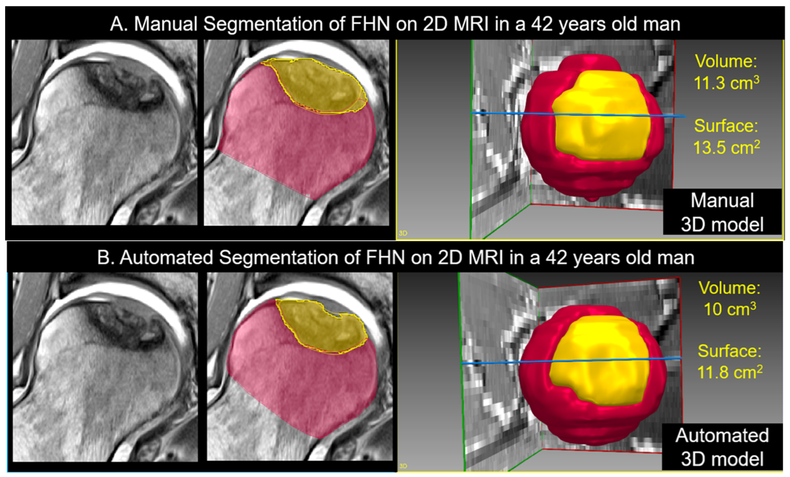 A Deep Learning Method for Quantification of Femoral Head Necrosis ...