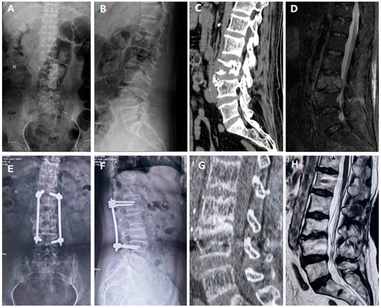 A Comparison of Negative Pressure and Conventional Therapy in Spine ...