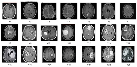 JPM | Free Full-Text | Brain Tumor Classification Using Meta-Heuristic ...