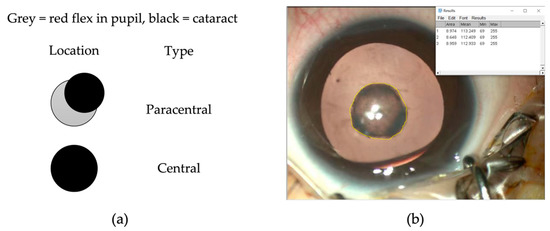 Surgical Outcomes of Lensectomy-Vitrectomy with Primary Intraocular ...