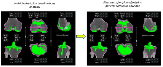 Functional Alignment Philosophy in Total Knee Arthroplasty—Rationale ...