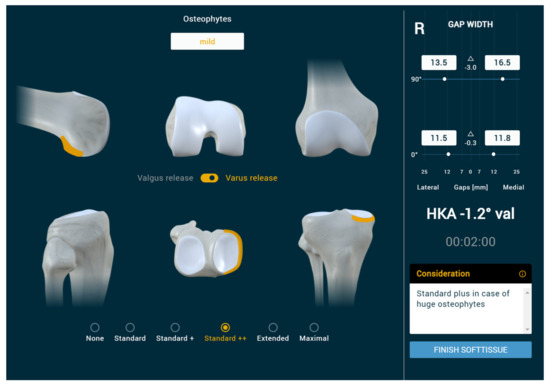 Digital TKA Alignment Training with a New Digital Simulation Tool (Knee ...