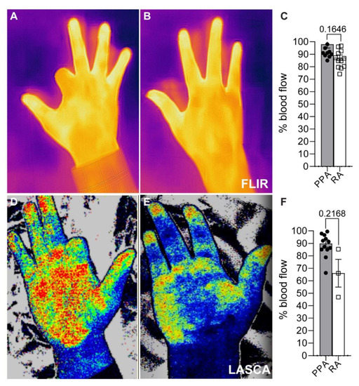 Personalized Treatment Decisions for Traumatic Proximal Finger ...