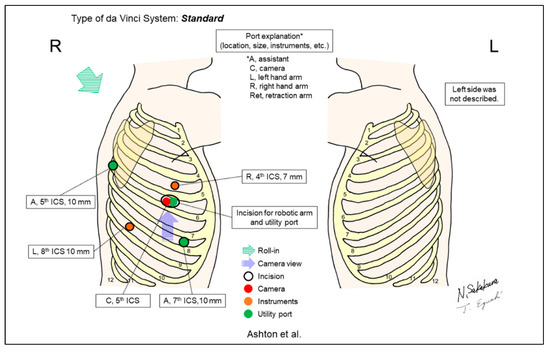 Port Placement Variations for Robotic Lung Resection: Focusing on Their ...
