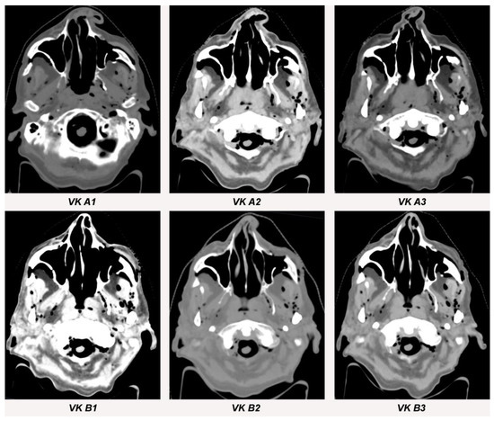 Metallic Artifact Reduction in Midfacial CT Scans Using Patient ...