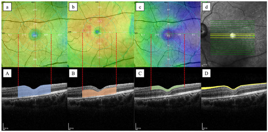 JPM | Free Full-Text | Analysis of Retinal Microstructure in Eyes with ...