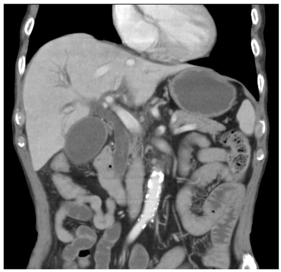 Comparing the Clinical Efficacy of Coil Embolization in GDA Stump ...