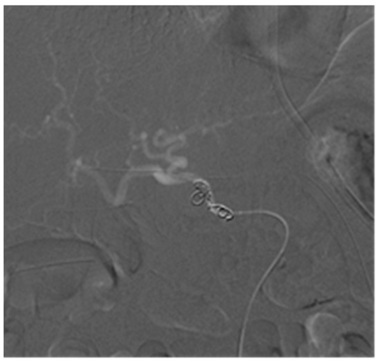 Comparing the Clinical Efficacy of Coil Embolization in GDA Stump ...