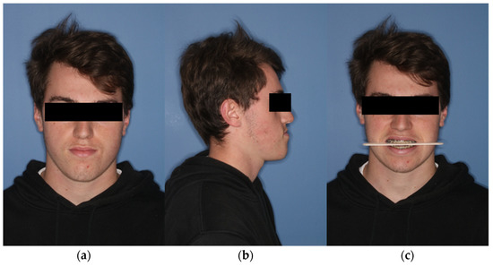 First-Hand Experience and Result with New Robot-Assisted Laser LeFort-I ...